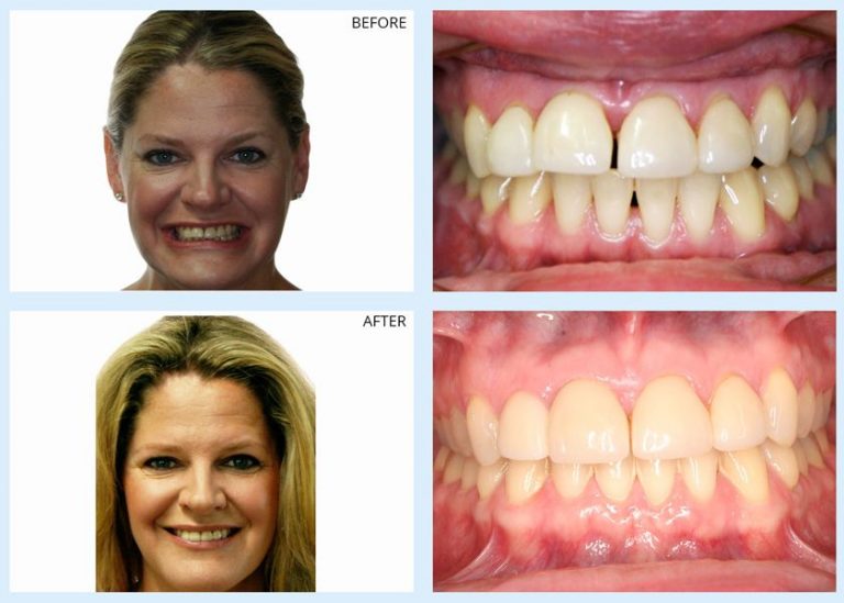 Invisalign - Avant/Après - Orthodontie Adulte