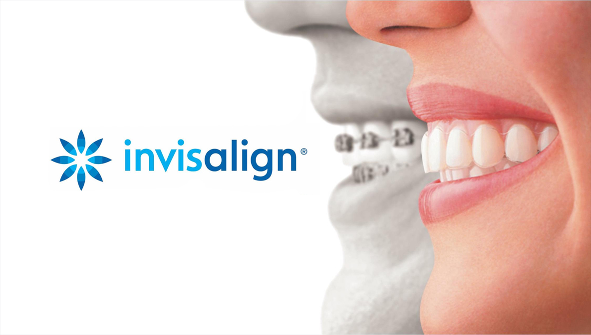 Invisalign - Prix et prise en charge mutuelle - Orthodontie Adulte